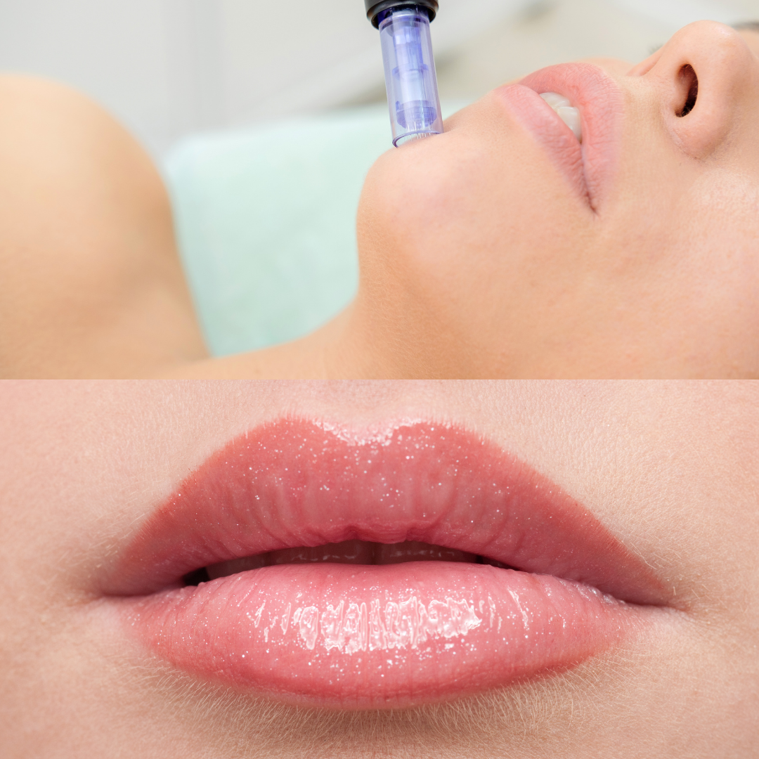 Combo - Hydra-Lips + Microneedling | La Belle Esthetic and Spa